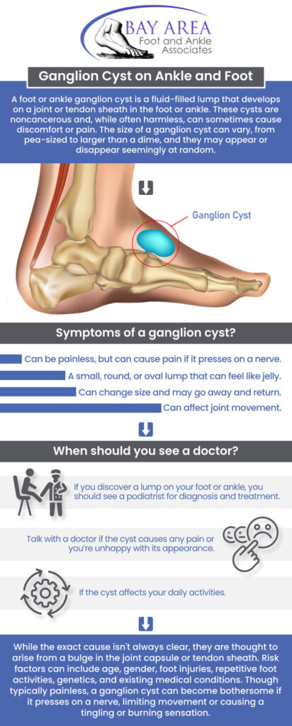 What Is a Ganglion Cyst in the Ankle? | Multiple Locations