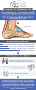 What Is a Ganglion Cyst in the Ankle? | Multiple Locations